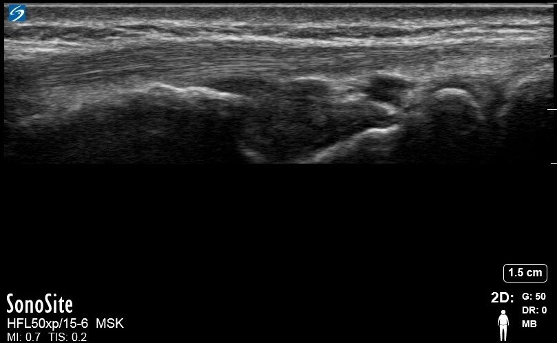 Wrist Abductor Pollicis Longus And Extensor Pollicis Brevis 2 Image